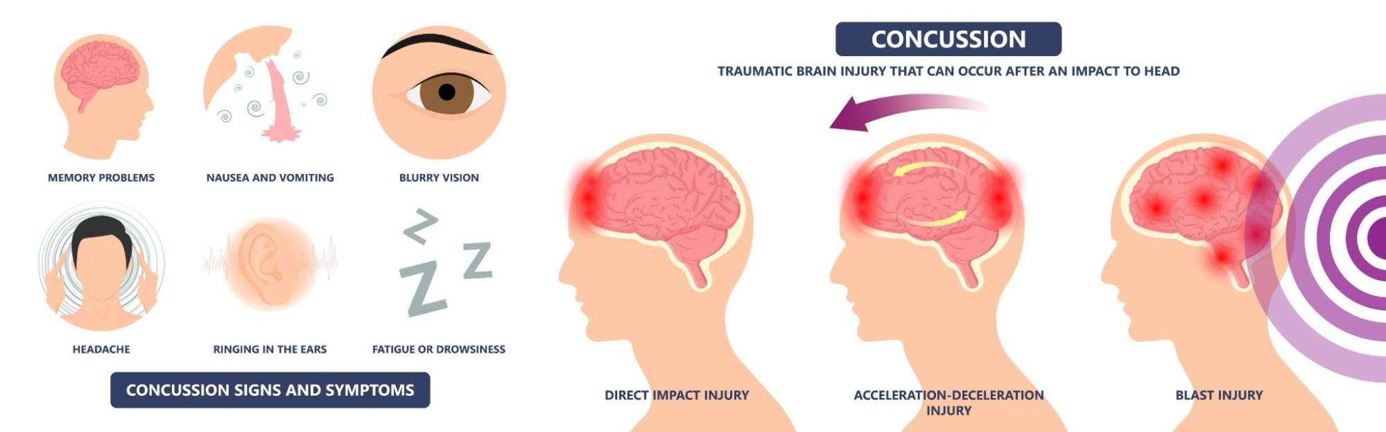How Long Does a Concussion Last? - Alliance Orthopedics