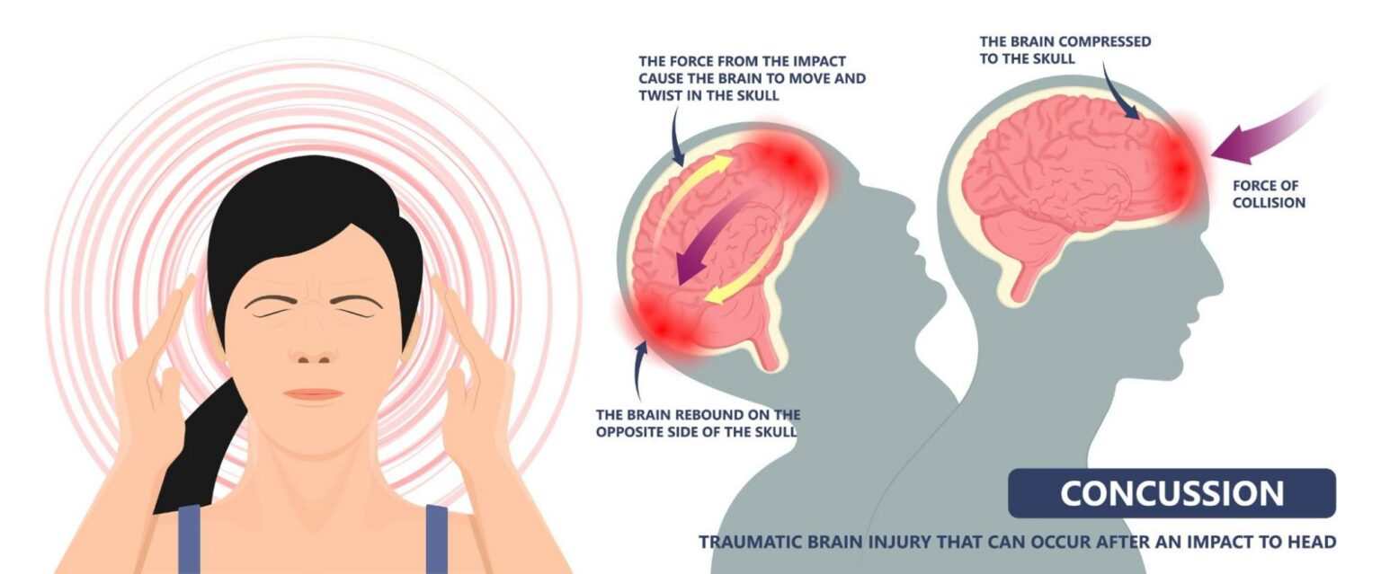 How Long Does a Concussion Last? - Alliance Orthopedics